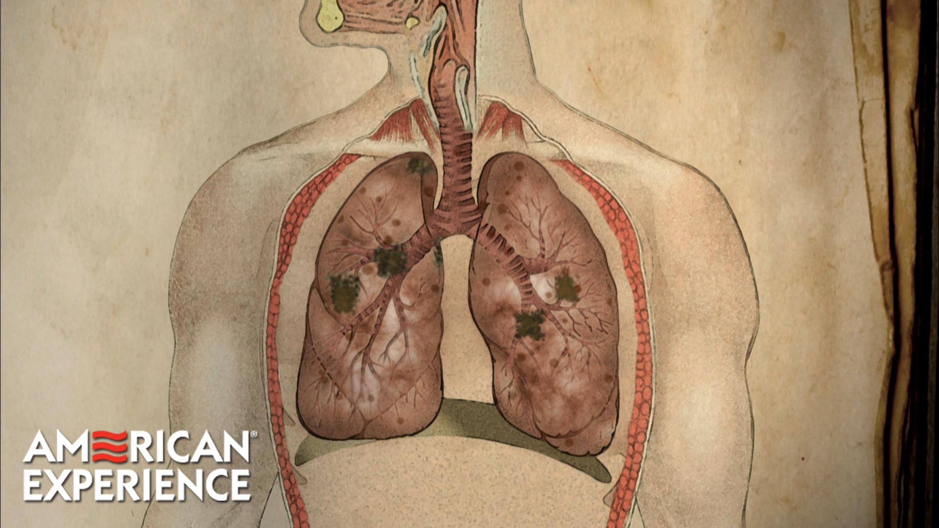 Tuberculosis in America: The Discovery That Germs Cause Disease | PBS ...