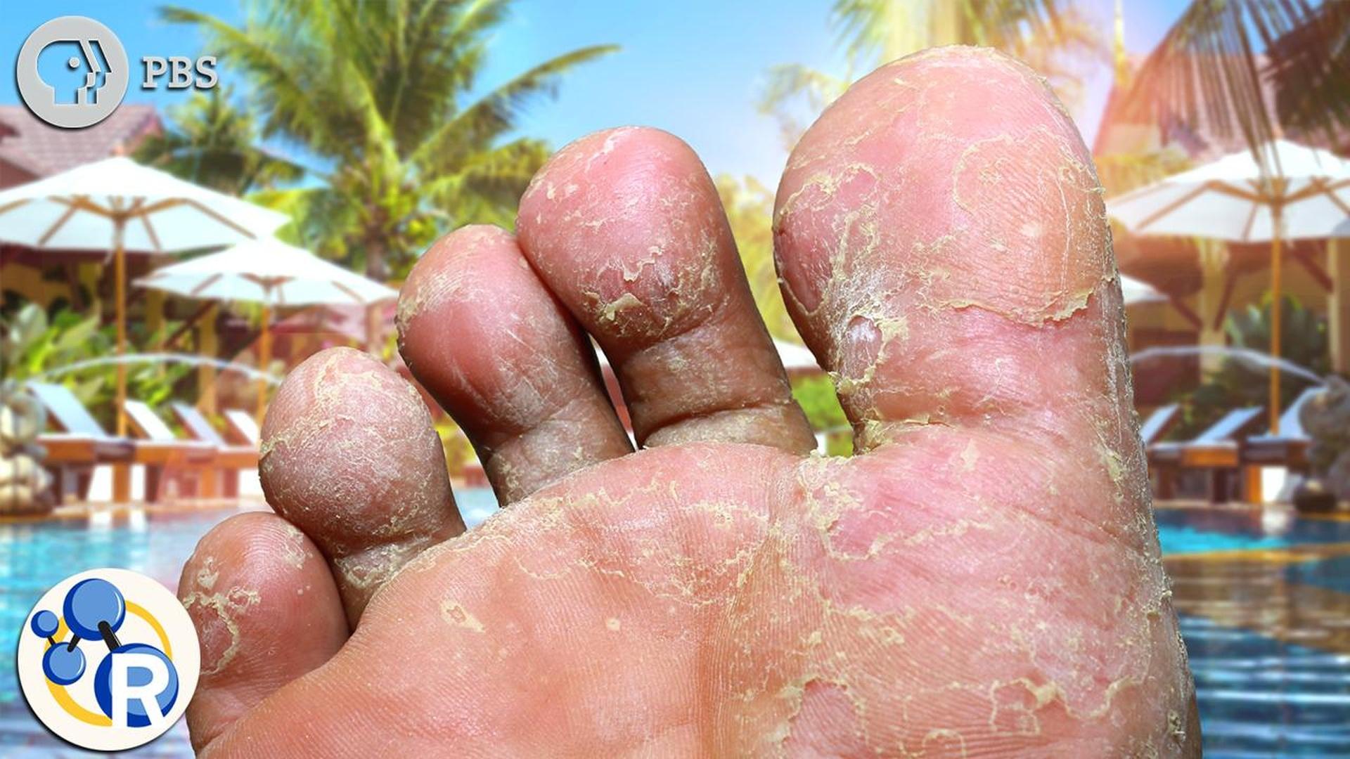 What is Ringworm and How Do You Get Rid of It? | Reactions | ALL ARTS