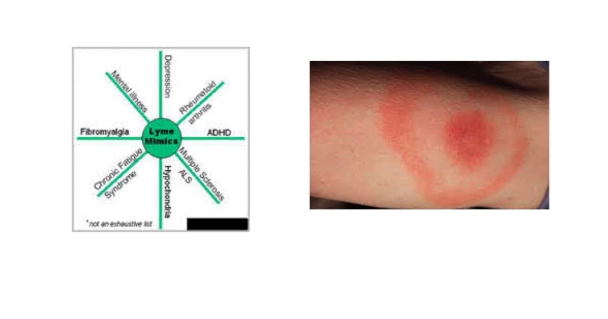 UNC-TV Science | Lyme Disease | PBS