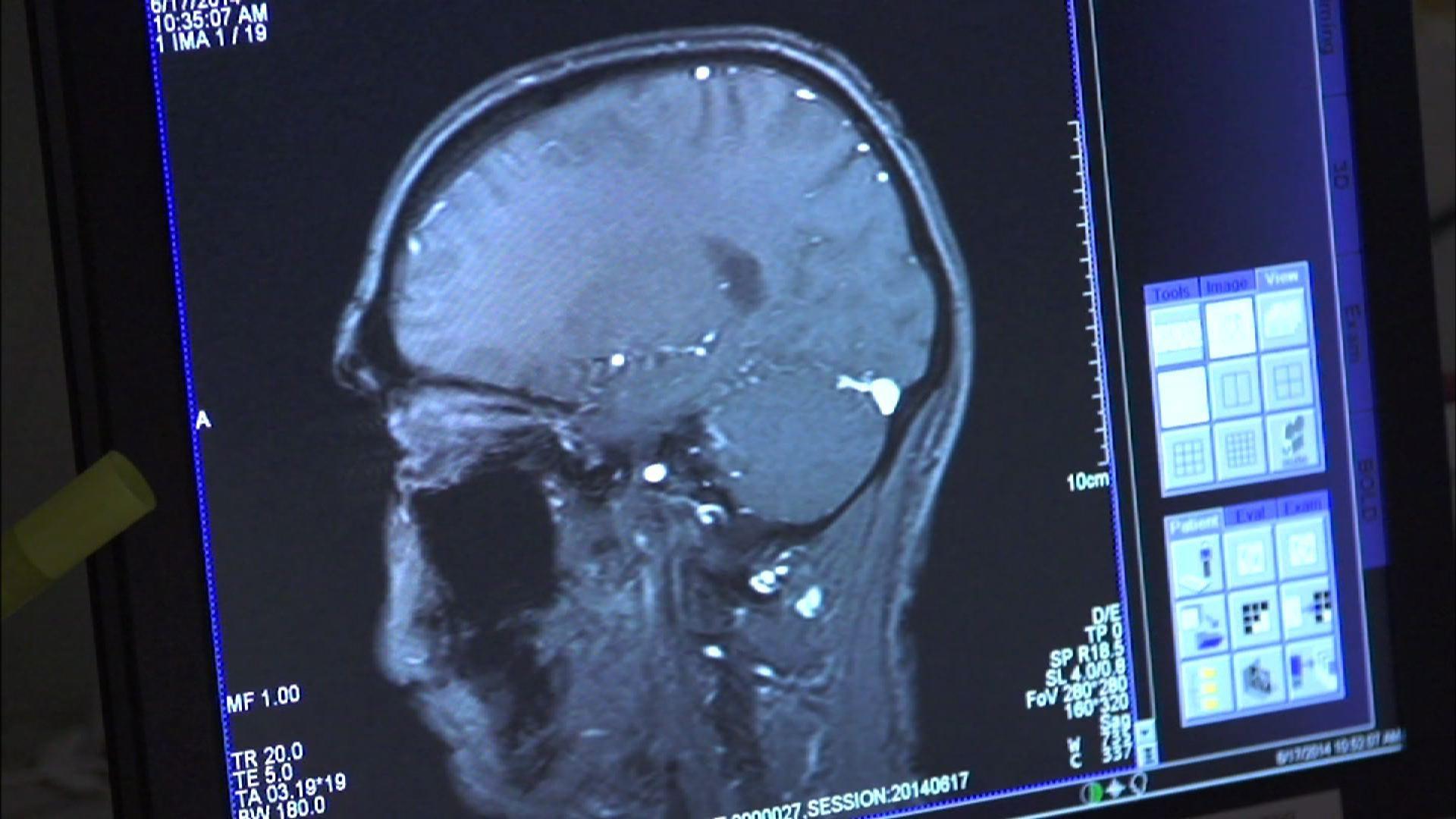 Connecting strength and vulnerability of the creative brain | PBS ...