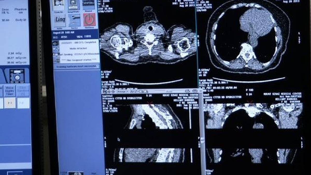 Can CT scans for smokers save lives? | PBS NewsHour | THIRTEEN - New ...