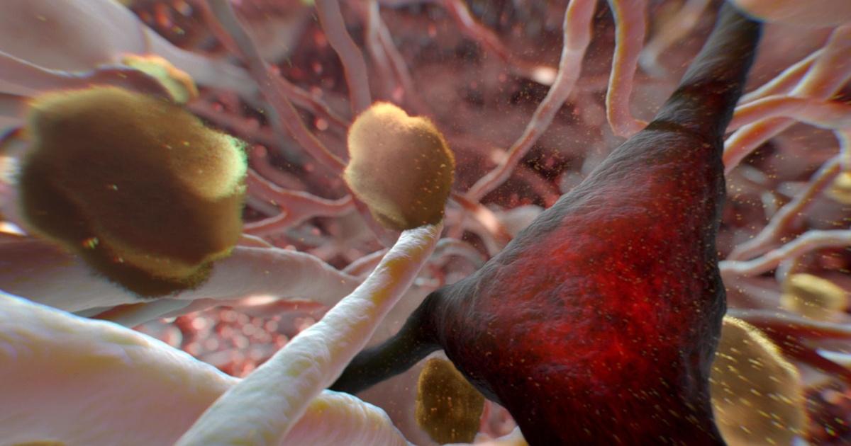 NOVA | Can Alzheimer's Be Stopped? | Season 43 | Episode 8 | PBS