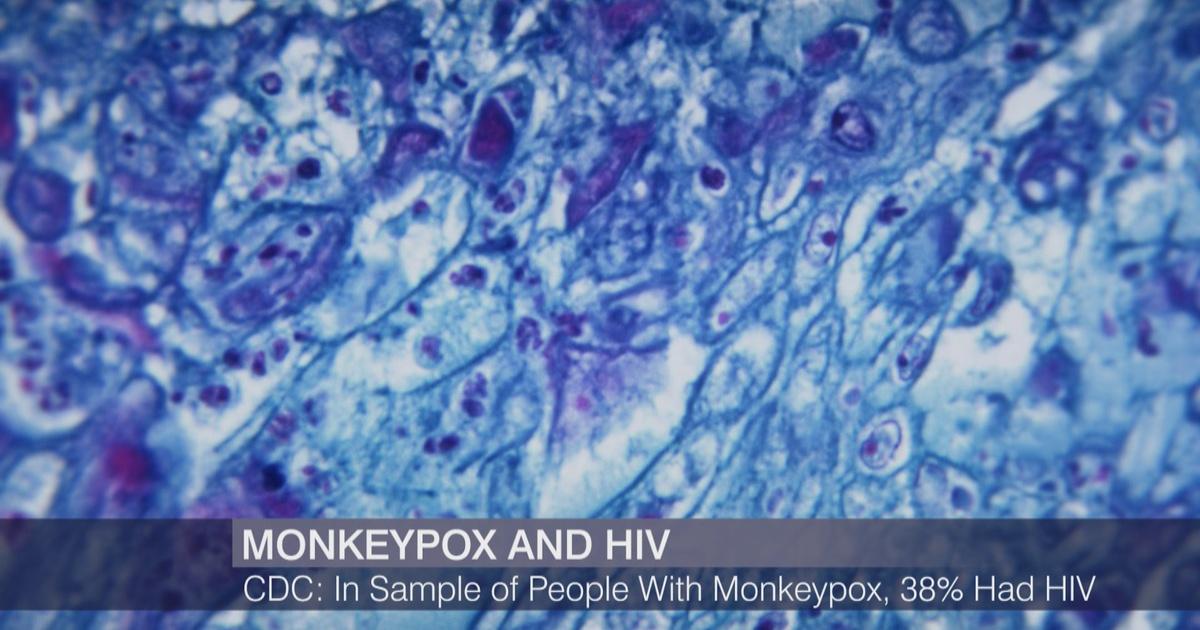 Chicago Tonight | CDC Report Studies Monkeypox and HIV Infection Rates ...